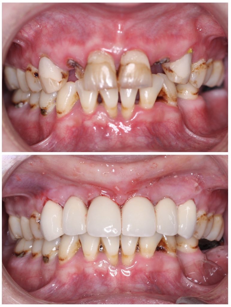 Crowns & Bridges – Fitzroy Dental