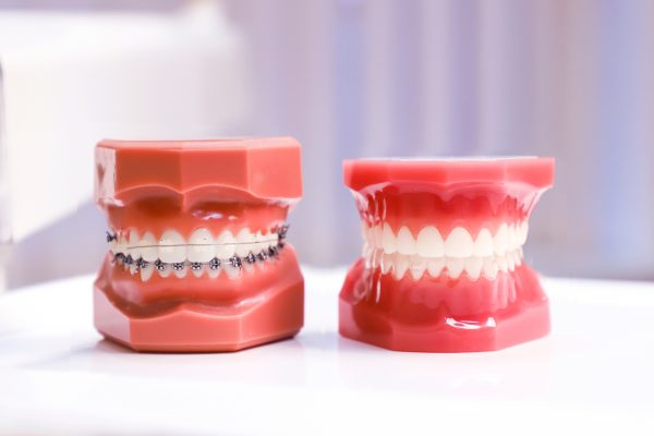 Traditional & Ceramics – Fitzroy Dental